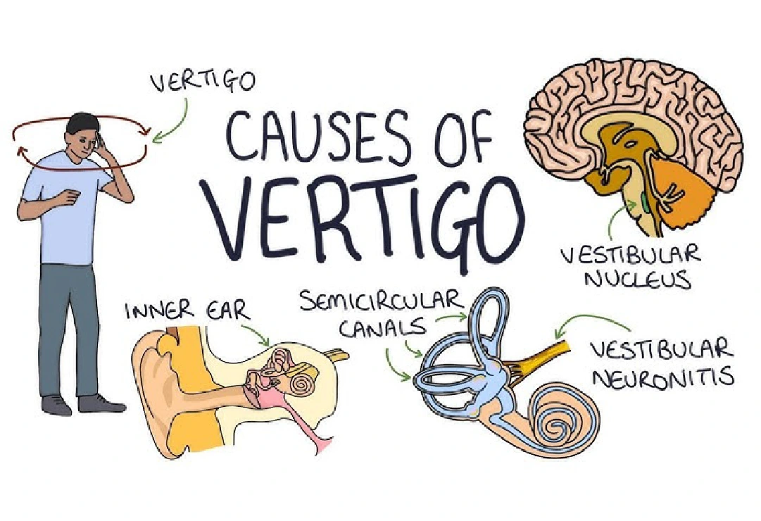 Vertigo : A Comprehensive Guide to Types, Causes, Symptoms, and ...