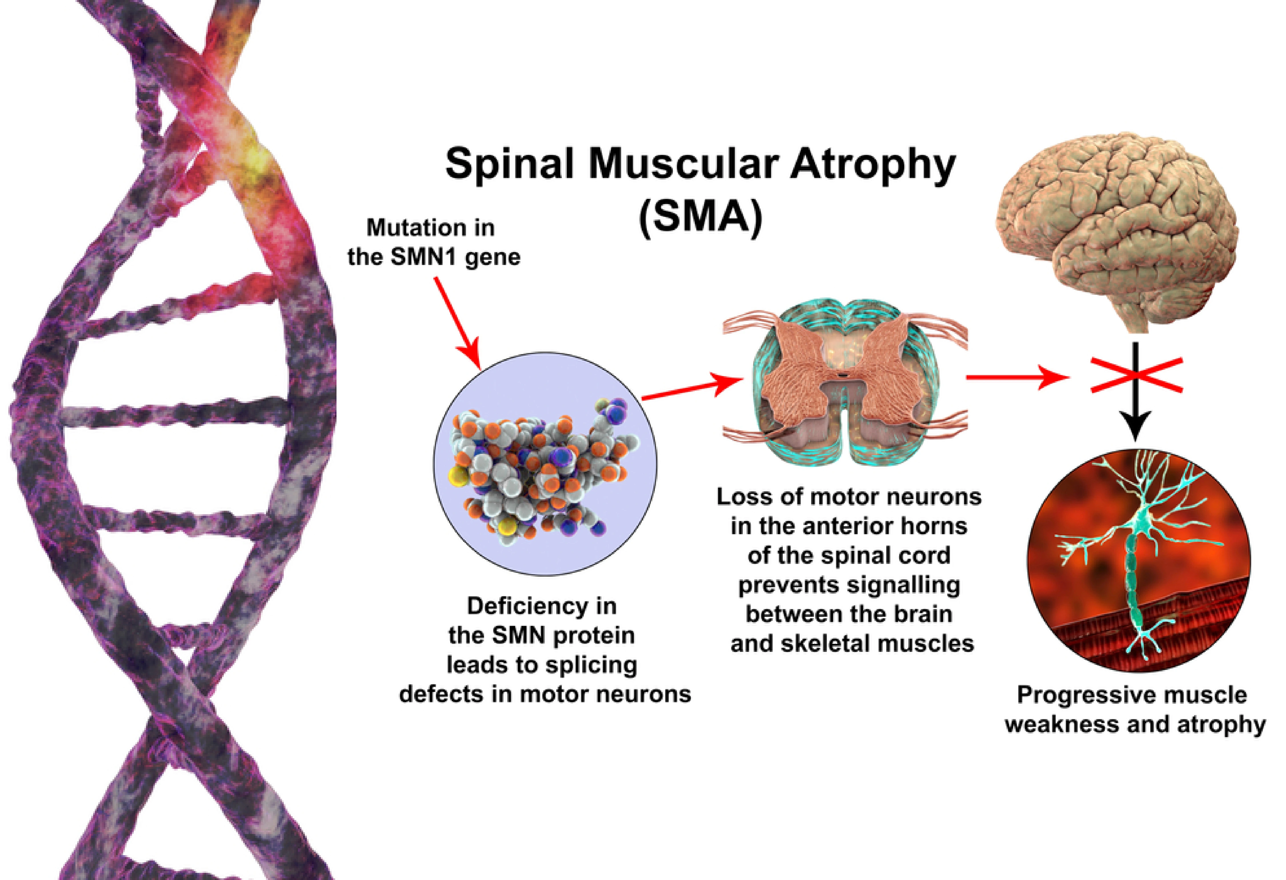 What is Spinal Muscular Atrophy? Causes, Symptoms, and How It’s Treated ...