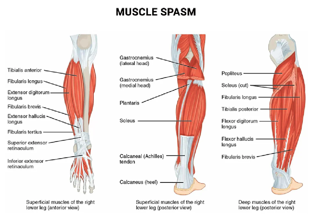 Muscle Spasms Explained: Causes, Warning Signs, and Prevention Tips | IBS