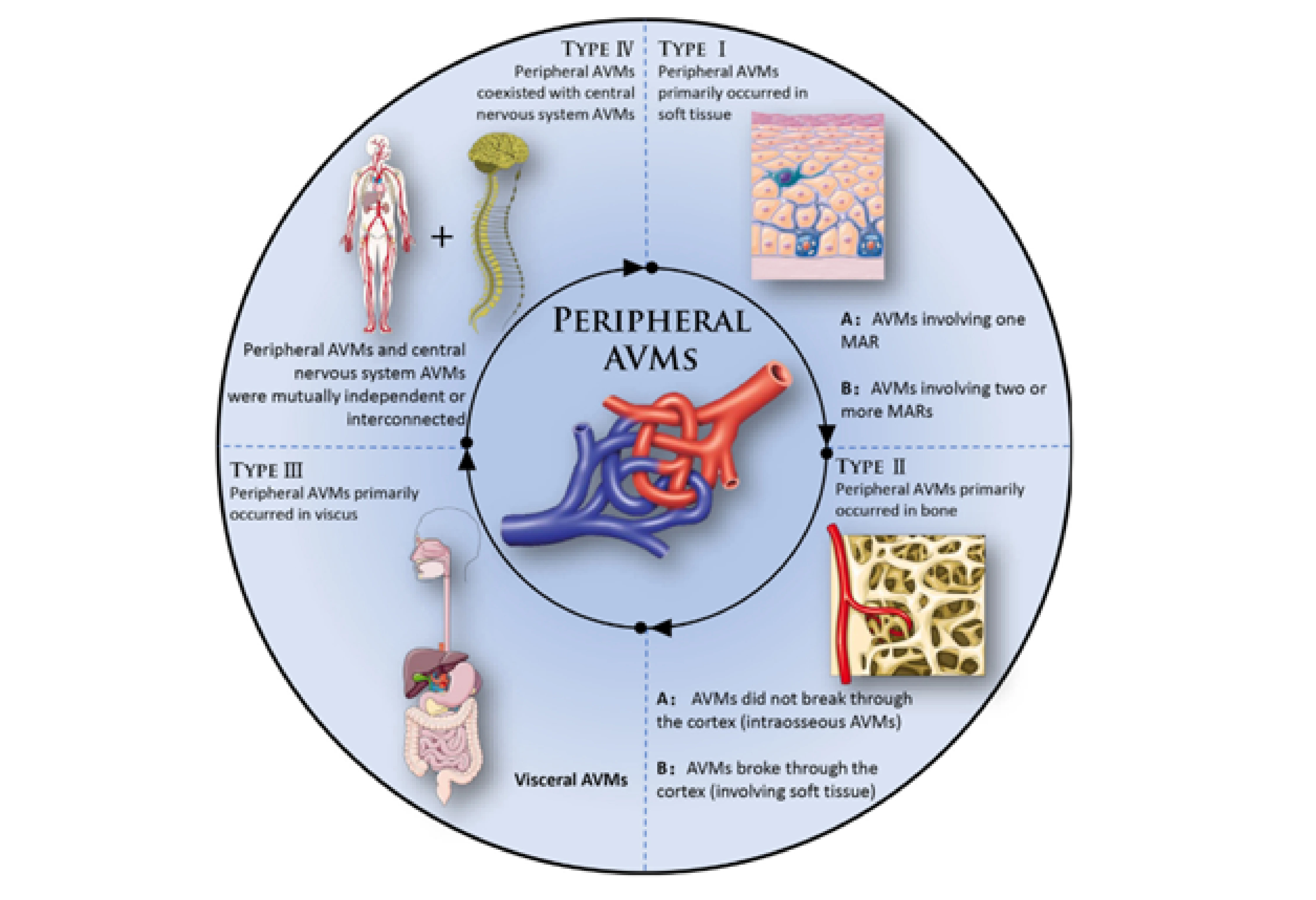 Arteriovenous Malformation (AVM): Symptoms, Risks & Treatments | IBS ...