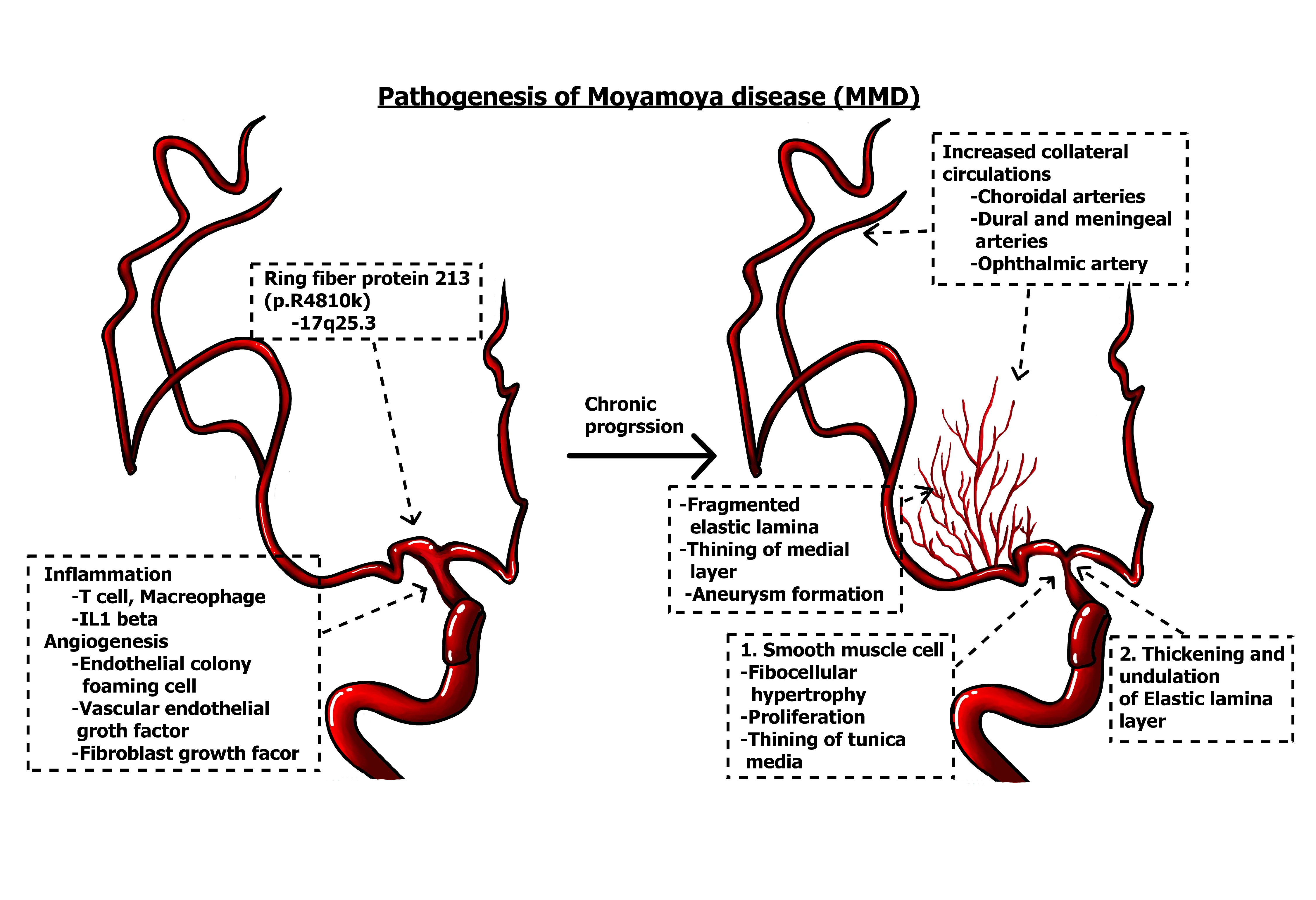 All You Need to Know About Moyamoya Disease | IBS Hospital