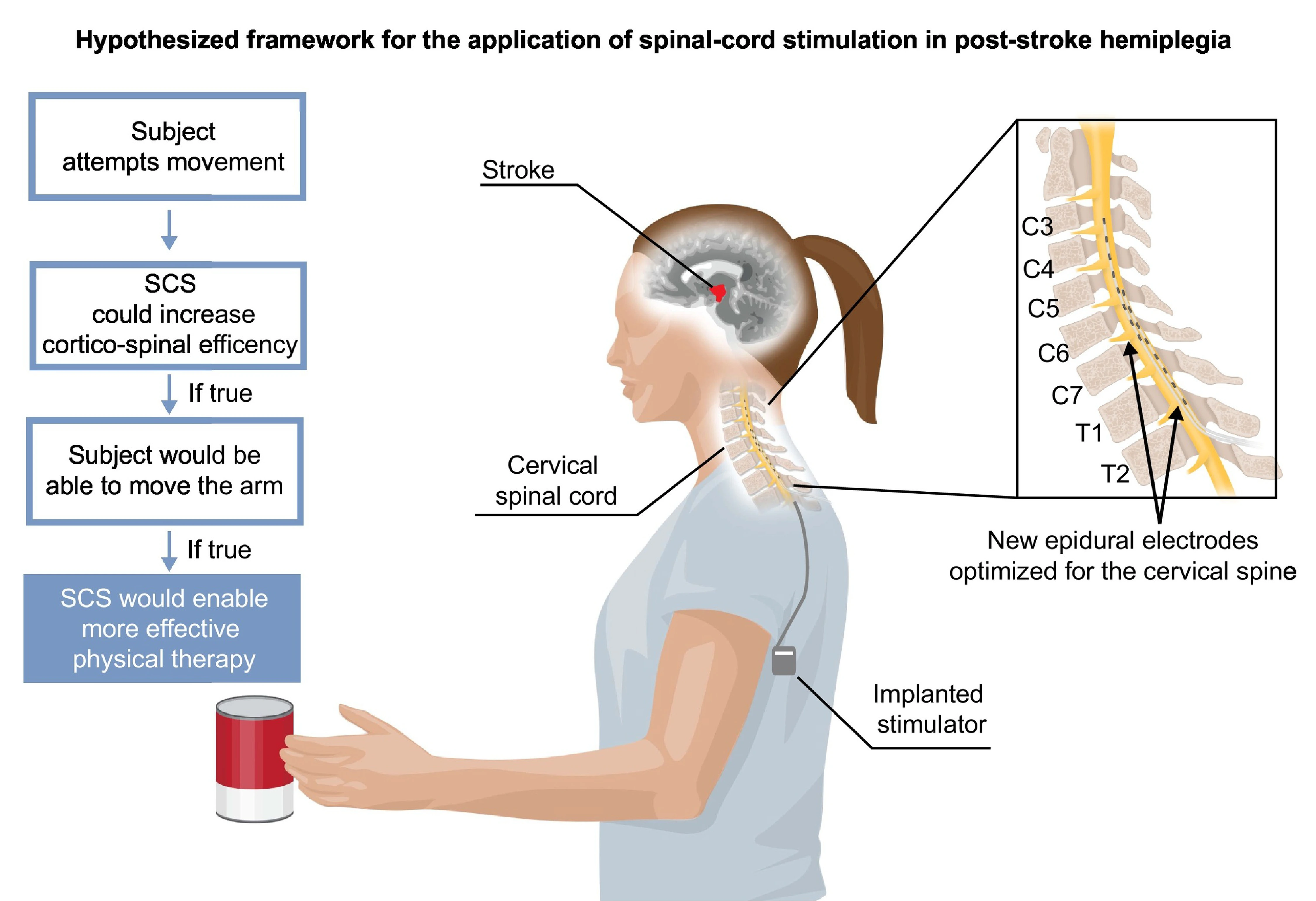 Spinal Stroke Decoded: Symptoms, Causes & Recovery Options | IBS Hospital