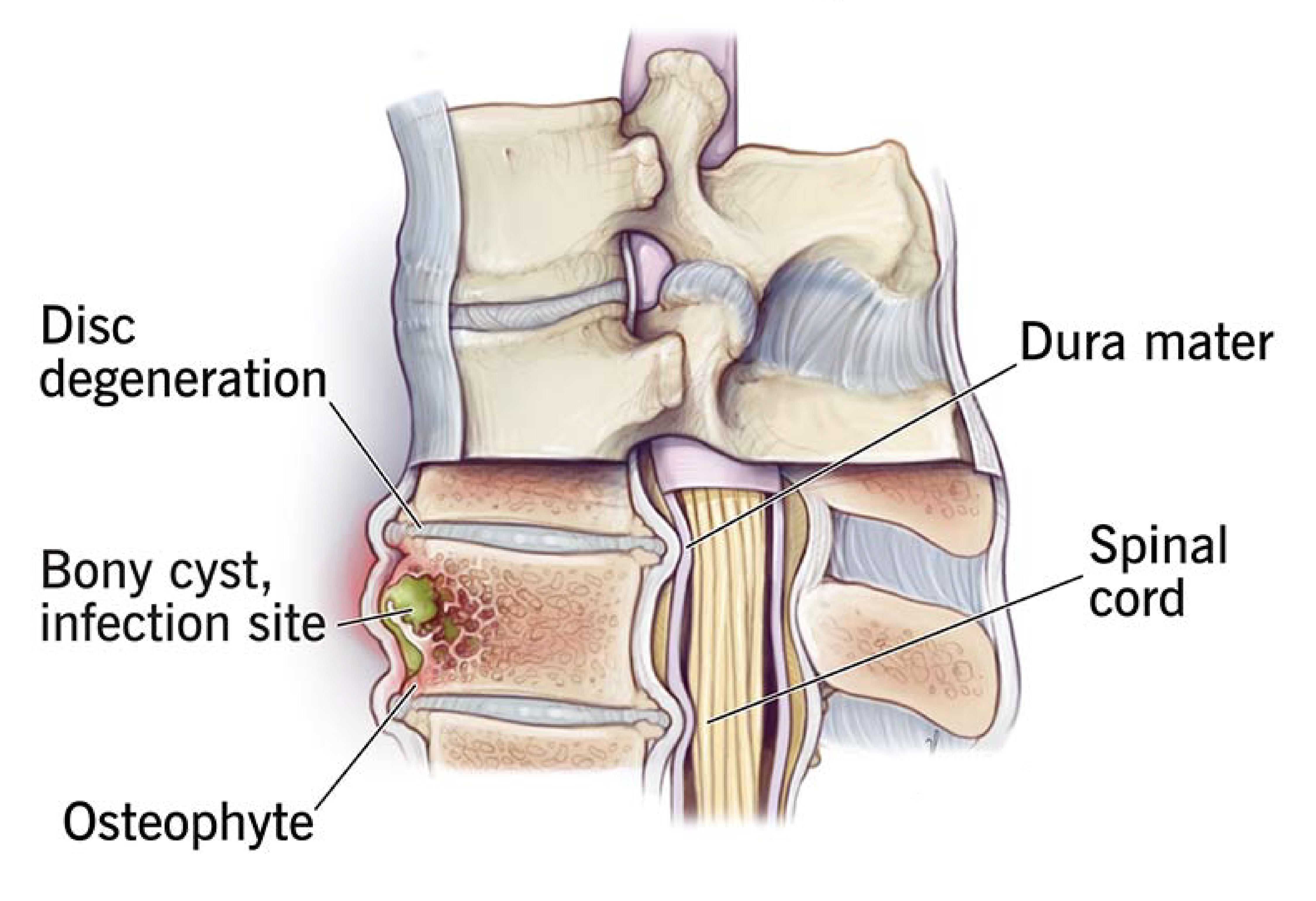 Spinal Infections: Causes, Symptoms, and Treatment Options | IBS Hospital