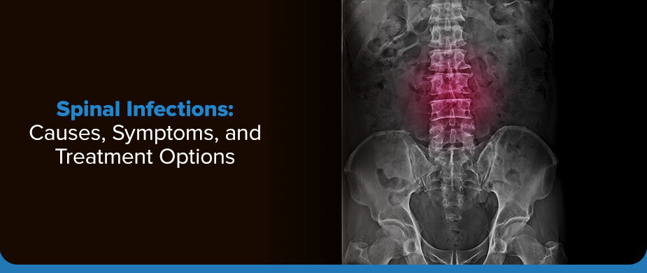 Spinal Infections: Causes, Symptoms, and Treatment Options | IBS Hospital