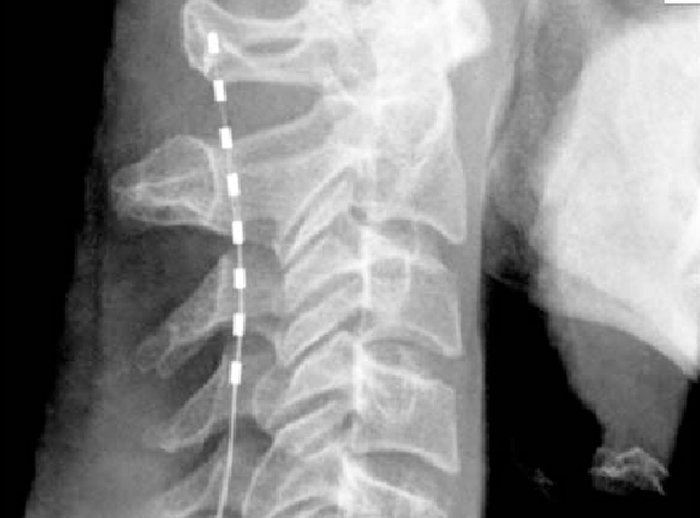 Best Neck Pain Solution With High Cervical Stimulation | IBS Hospital