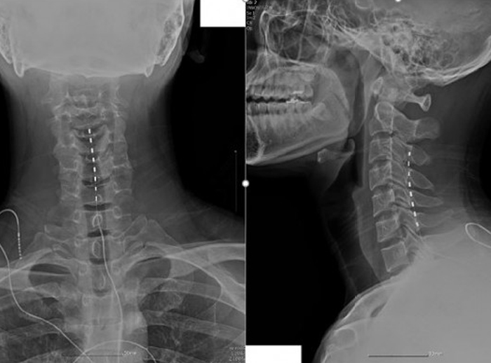 Best Neck Pain Solution With High Cervical Stimulation | IBS Hospital