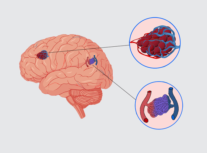Brain Vascular Malformation: Types, Causes and Treatments