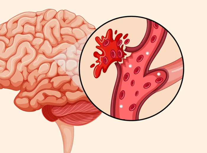 Hemorrhagic Stroke - Symptoms & Treatment at IBS Hospital