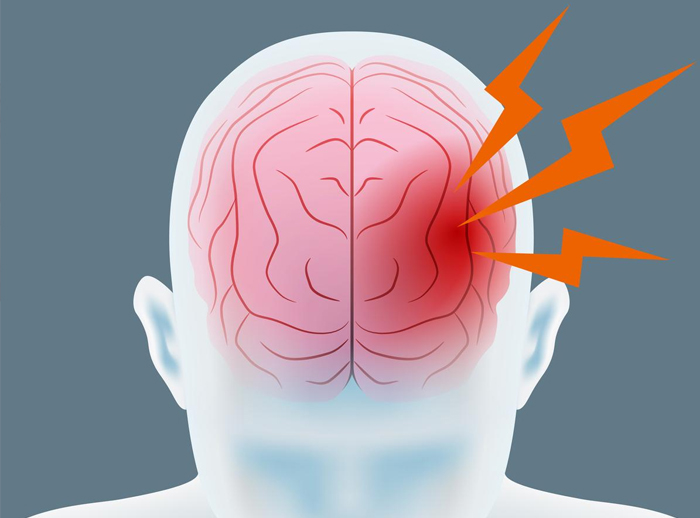 Hemorrhagic Stroke - Symptoms & Treatment at IBS Hospital