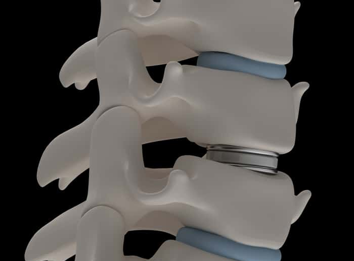 Cervical Disc Replacement and Surgery - (Spine Care)