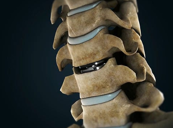 Cervical Disc Replacement and Surgery - (Spine Care)