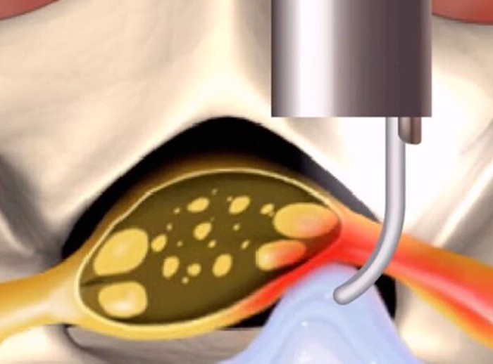 Endoscopic Discectomy Recovery in Delhi - IBS Hospital