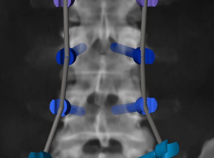 Navigation Guided Lumbar Fixation Benefits - IBS Hospital