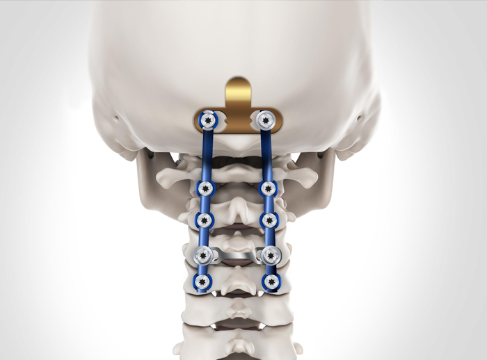Posterior Cervical Fixation In Delhi - Spine Care