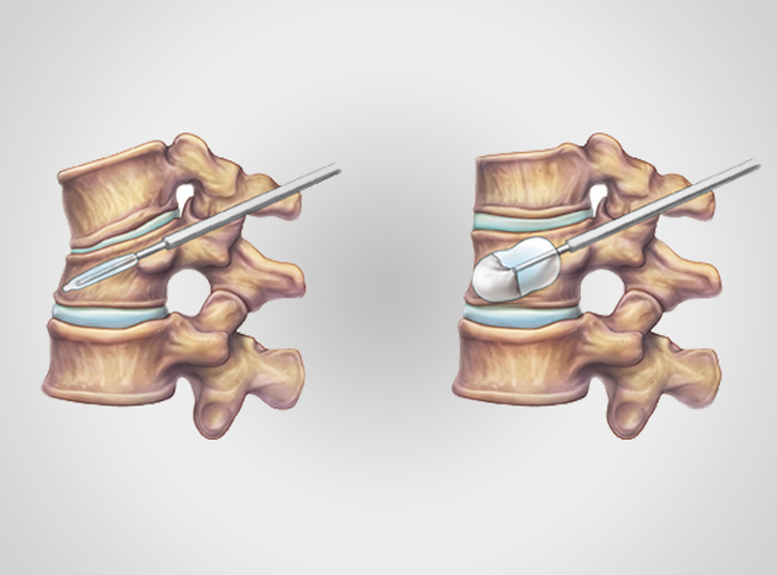 Microscopic Discectomy Recovery and Treatment in Delhi