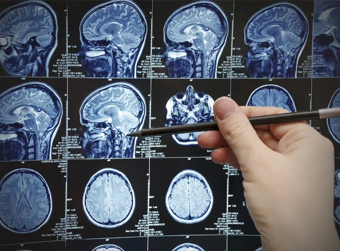 Brain Aneurysms - Symptoms Diagnosis and Treatment