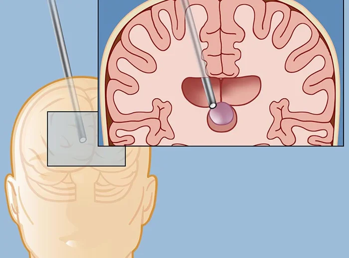 Colloid Cyst Symptoms, Surgery and Treatment | IBS Hospital