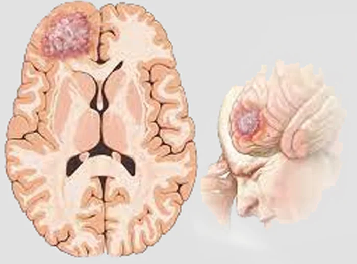 Advanced Glioma & Glioblastoma Treatment in Delhi - IBS Hospital