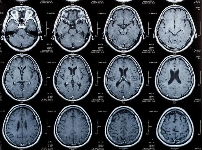 Moyamoya Disease - Causes ,Symptoms and Treatment