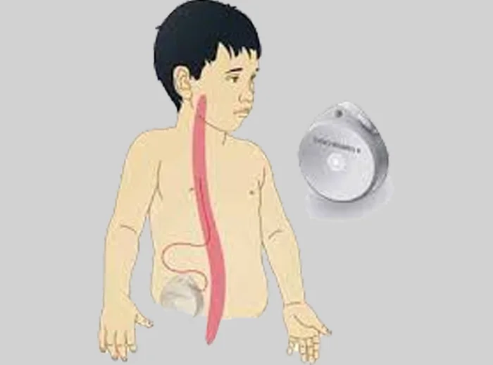 Intrathecal Baclofen Pump