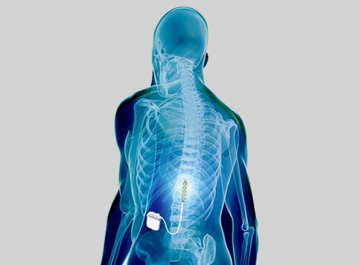 Spinal Cord Injury Treatment in Delhi | Epidural Stimulation at IBS ...