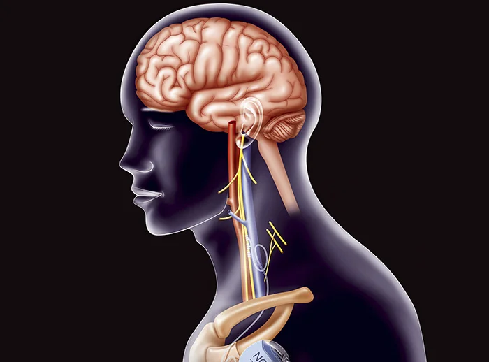 Vagus Nerve Stimulation Treatment in Delhi - IBS Hospital