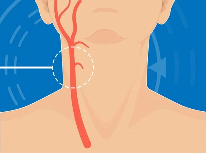 Transient Ischemic Attack - Symptoms and Causes