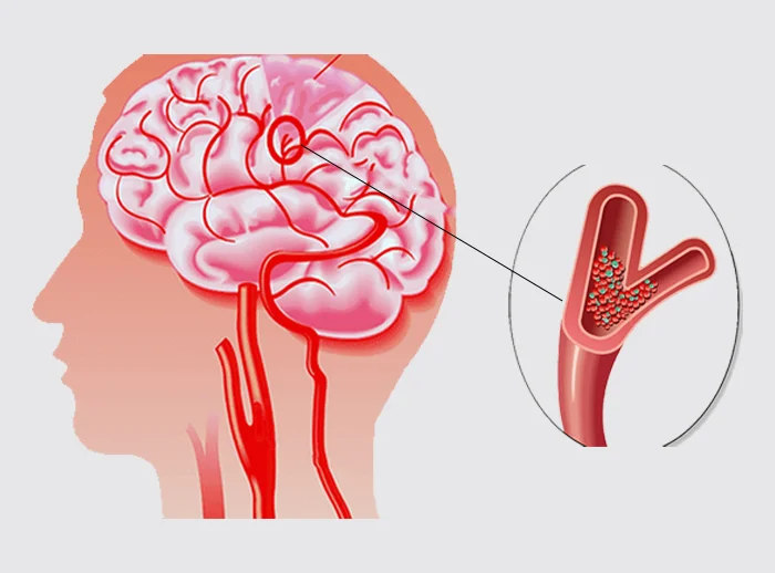 Transient Ischemic Attack - Symptoms and Causes