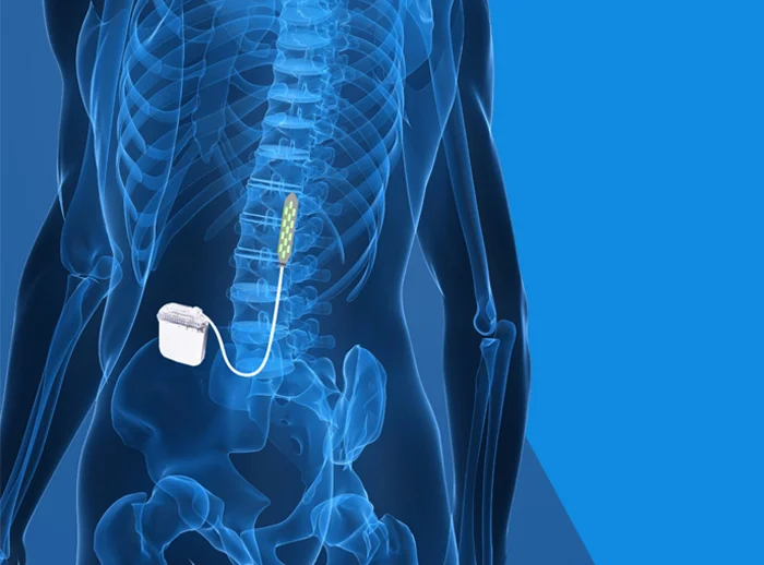 Spinal Cord Stimulation Treatment and Hospital in Delhi