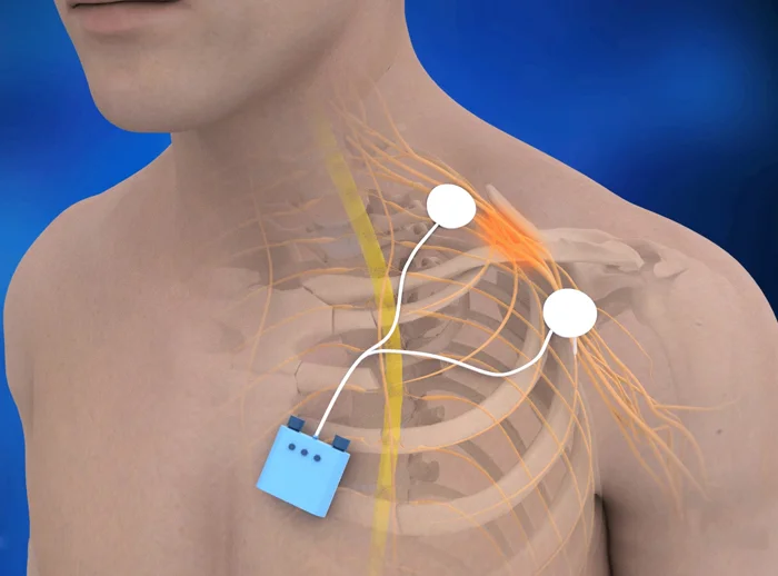 Peripheral Nerve Stimulation Neurosurgeons in Delhi