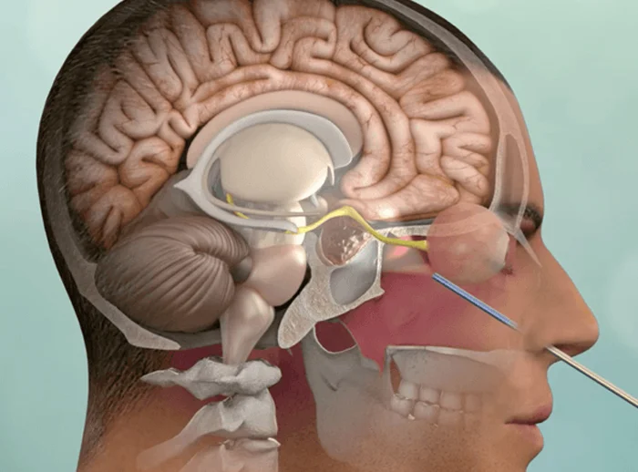 Esthesioneuroblastoma