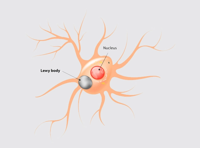 Lewy Body Dementia - Diagnosis , Symptoms and Treatment
