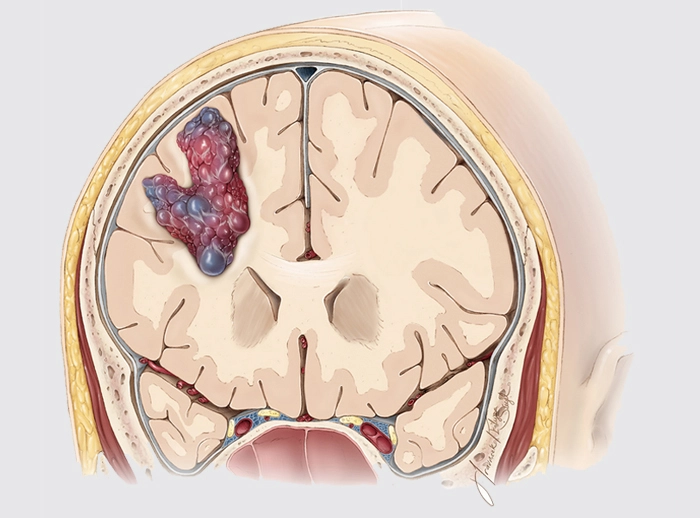 Cavernoma - Symptoms, Diagnostic and Treatments