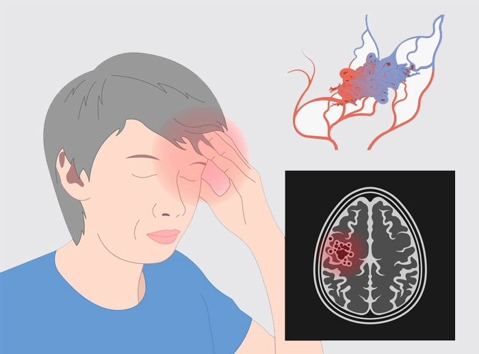 Cavernoma - Symptoms, Diagnostic and Treatments