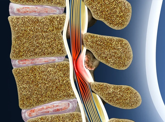 Minimal Invasive Spine Surgeries in Delhi - IBS Hospital