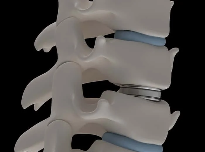 Cervical Disc Replacement and Surgery - (Spine Care)