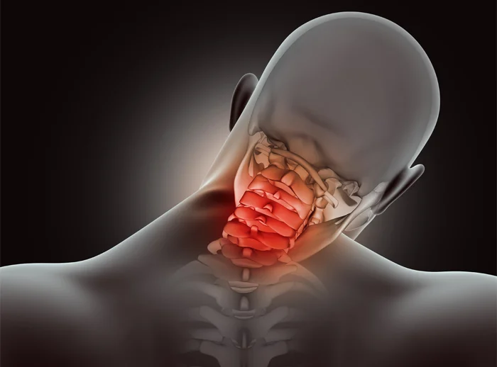 Posterior Cervical Fixation In Delhi - Spine Care
