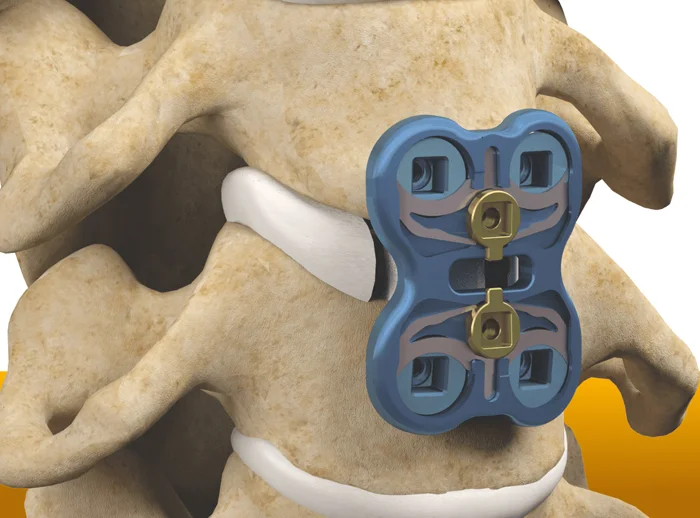 Anterior Cervical Discectomy and Fusion Treatment, Doctors in Delhi,