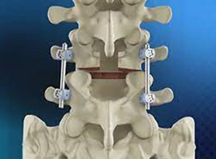 Posterior Lumbar Interbody Fusion (PLIF) in Delhi