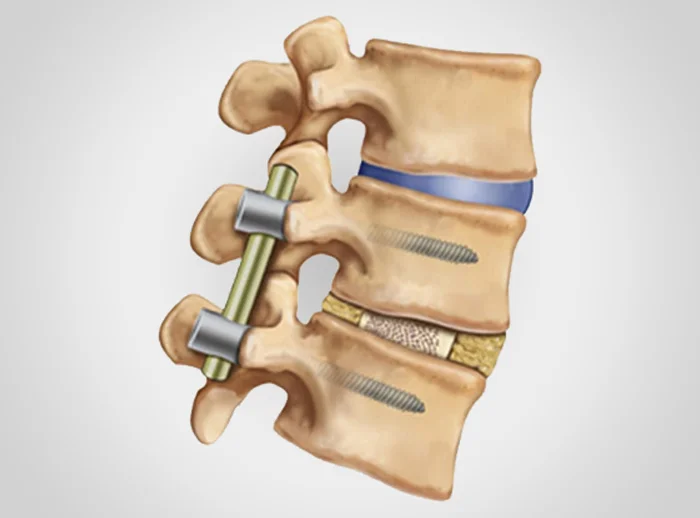 Posterior Lumbar Interbody Fusion (PLIF) in Delhi