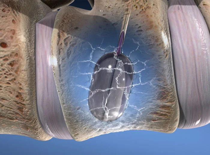 Vertebroplasty Kyphoplasty Treatment in Delhi - IBS Hospital