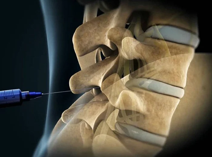 Spinal Injection Pain Management Treatment- IBS Hospital