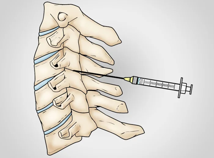 Spinal Injection Pain Management Treatment- IBS Hospital