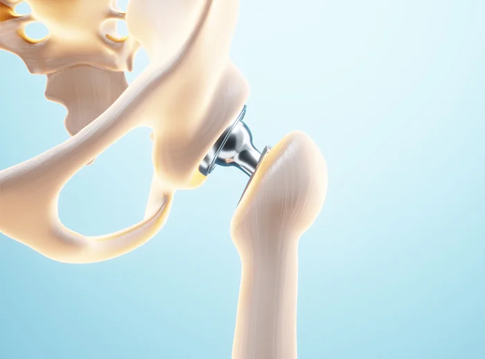 Best Hip Replacement Surgery in Delhi| IBS Hospital