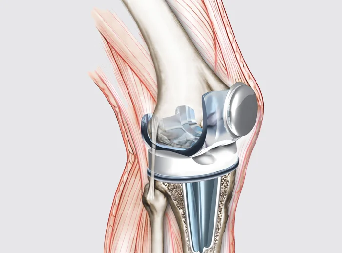 Knee Replacement Surgery in Delhi - IBS Hospital