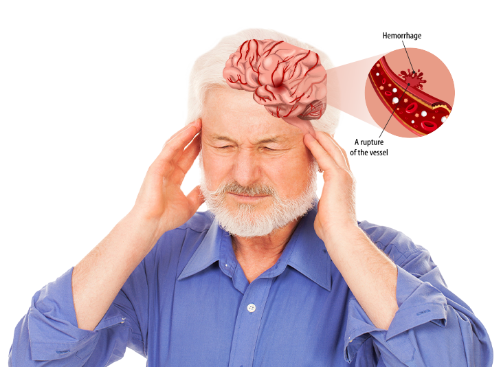 Hemorrhagic Stroke - Symptoms & Treatment at IBS Hospital