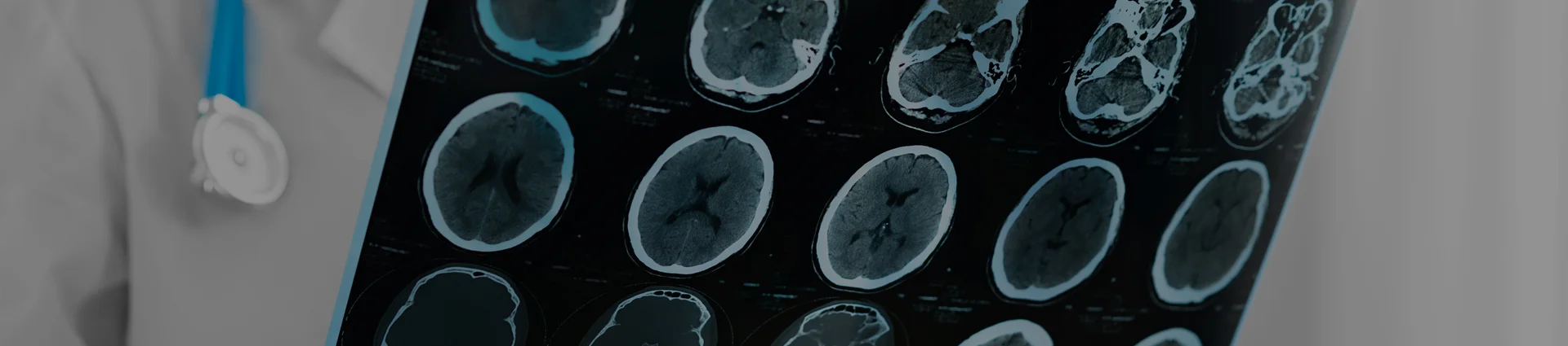 Amyotrophic Lateral Sclerosis (ALS) Treatment in Delhi