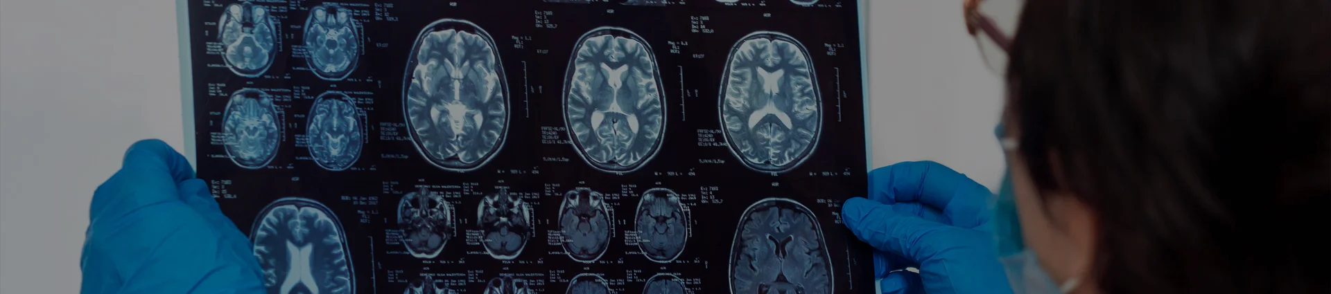 Colloid Cyst Symptoms, Surgery and Treatment | IBS Hospital