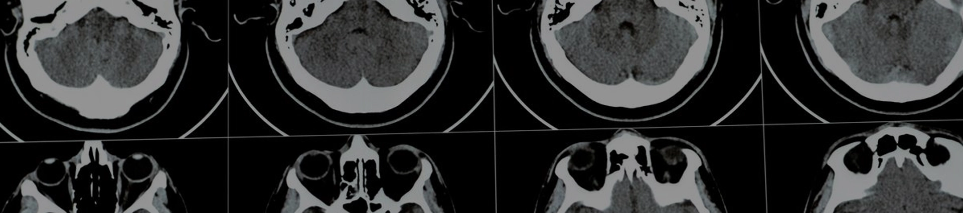 Cavernoma - Symptoms, Diagnostic and Treatments
