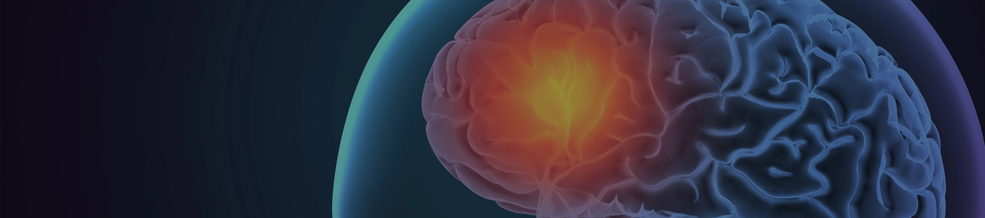 Intracerebral Haemorrhage causes & Treatment - IBS Hospital
